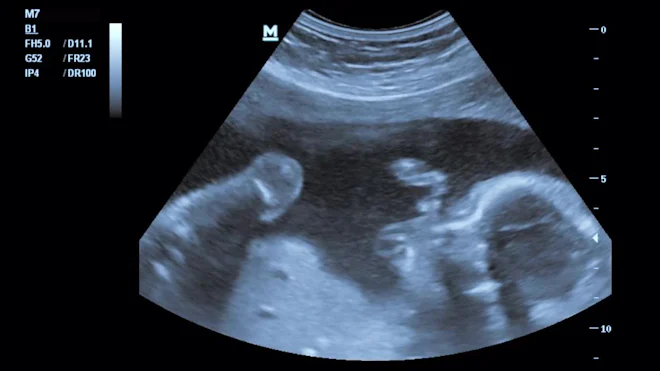 22 Weeks Ultrasound Profile