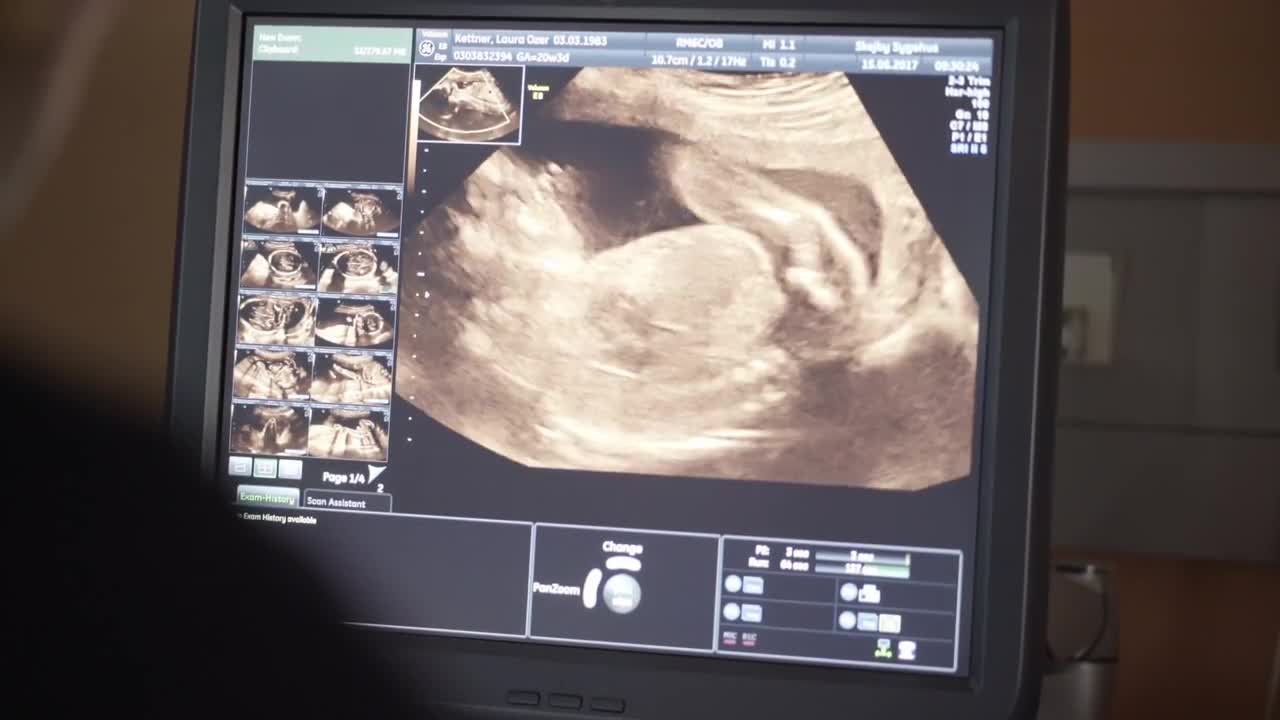 Ultrasound Of A Baby - Stock Video | Motion Array