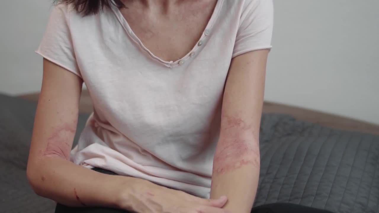 Atopic Dermatitis On Arms - Stock Video | Motion Array